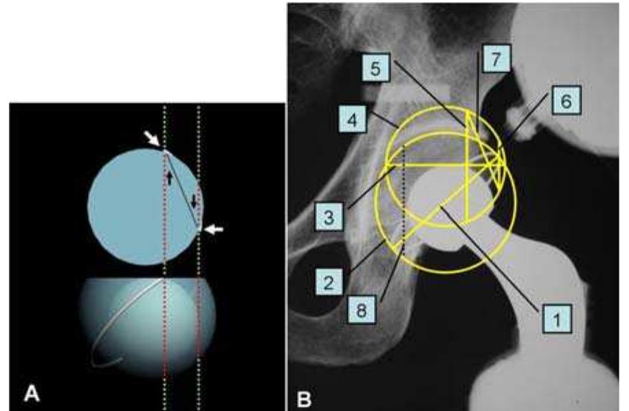 Figure 4 - Measurement of acetabular cup anteversion with