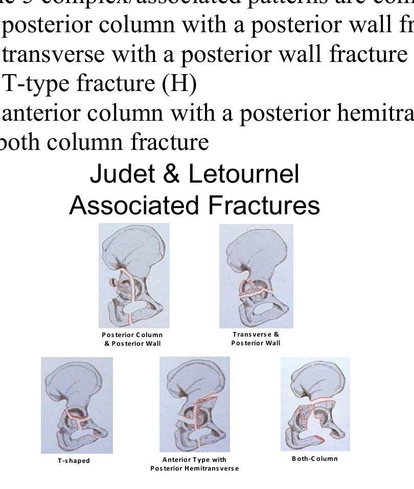 Figure 2 - from Classification of Acetabular fractures