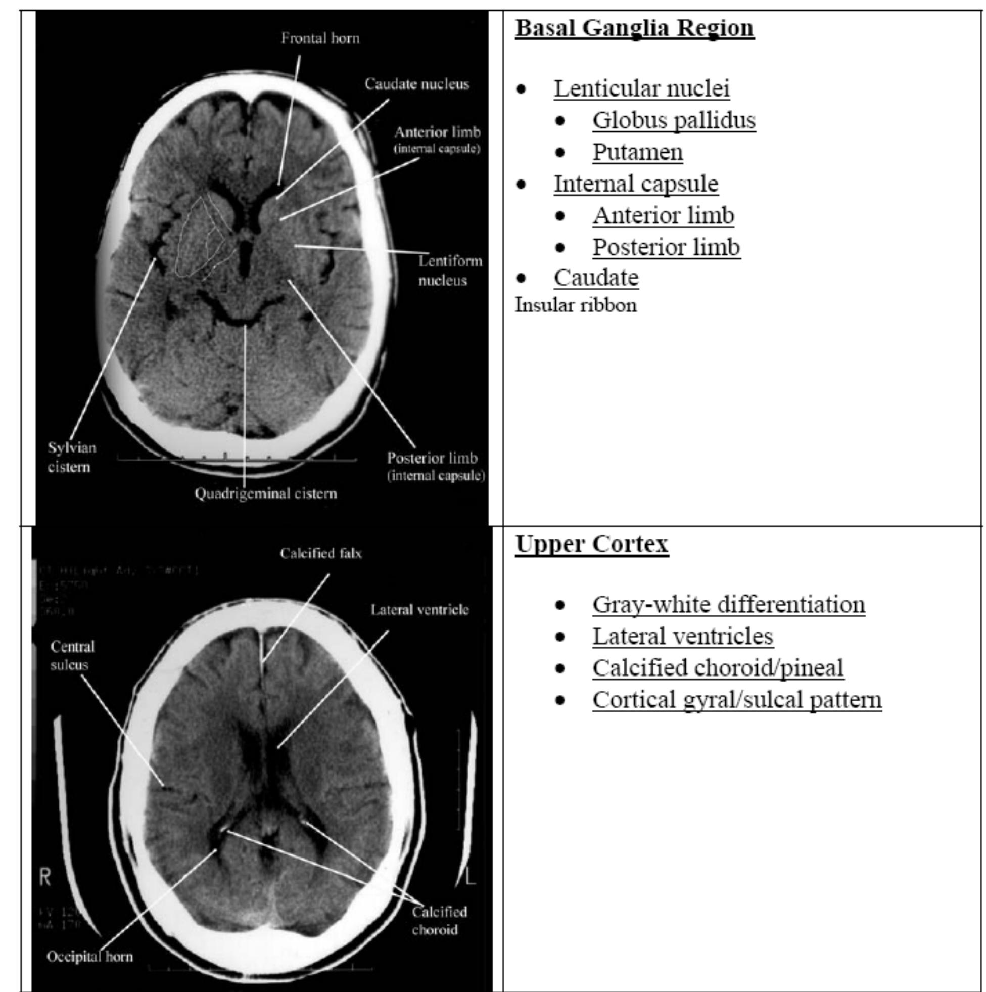 Figure 5 - ABCs of Head CT Interpretation in the Emergency