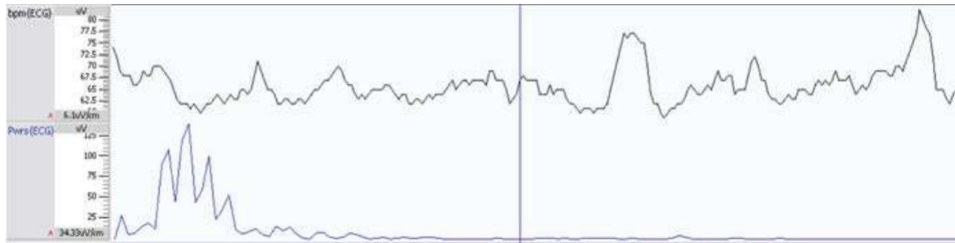 2. hrv detection: compressed view of 5 min section of a