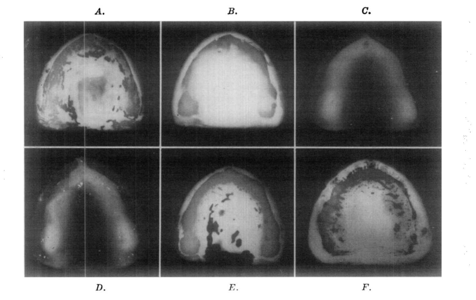 the mercury distribution is shown in dentures made from