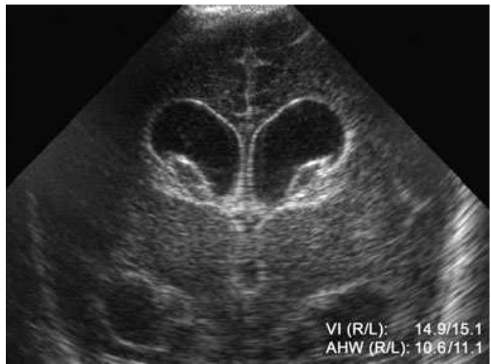 Ventricular ballooning on cranial ultrasound in a 13-day old