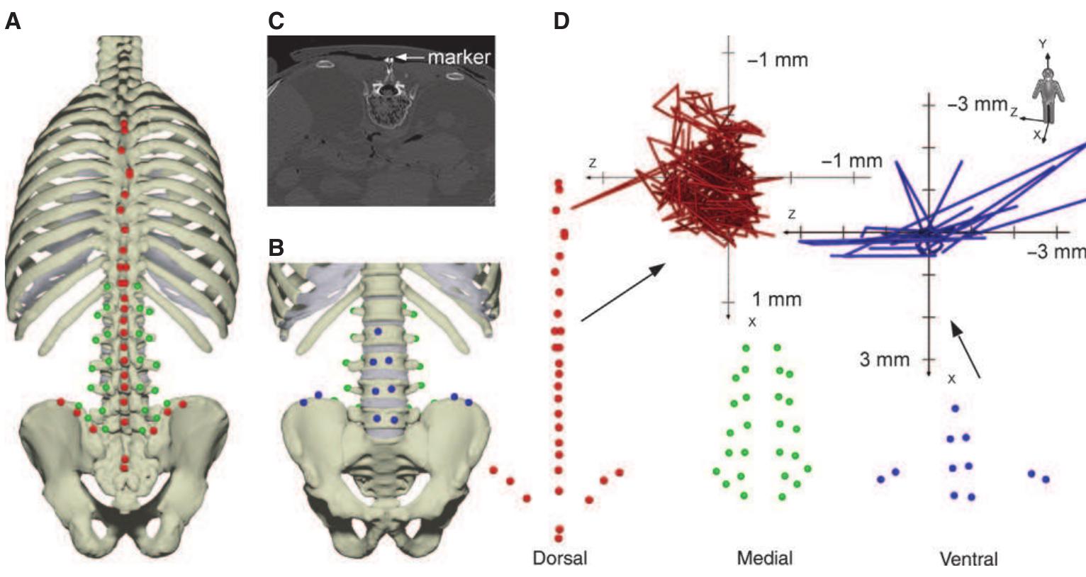 3d reconstruction of the spine, ribs and pelvis of the
