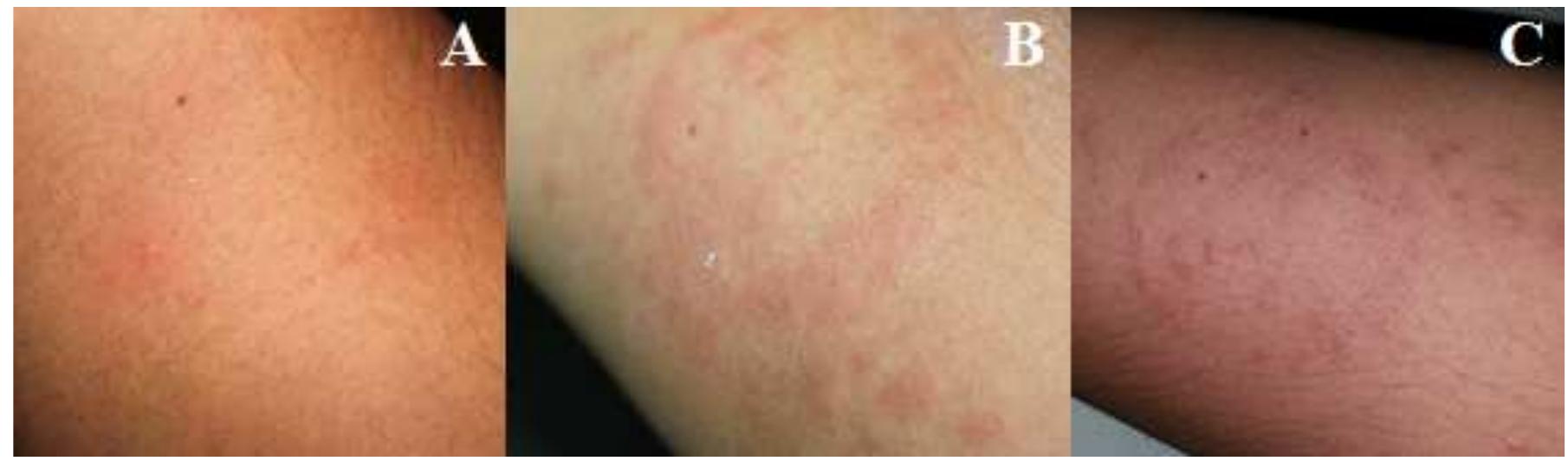 Our colony of cimex hemipterus came from various stages,