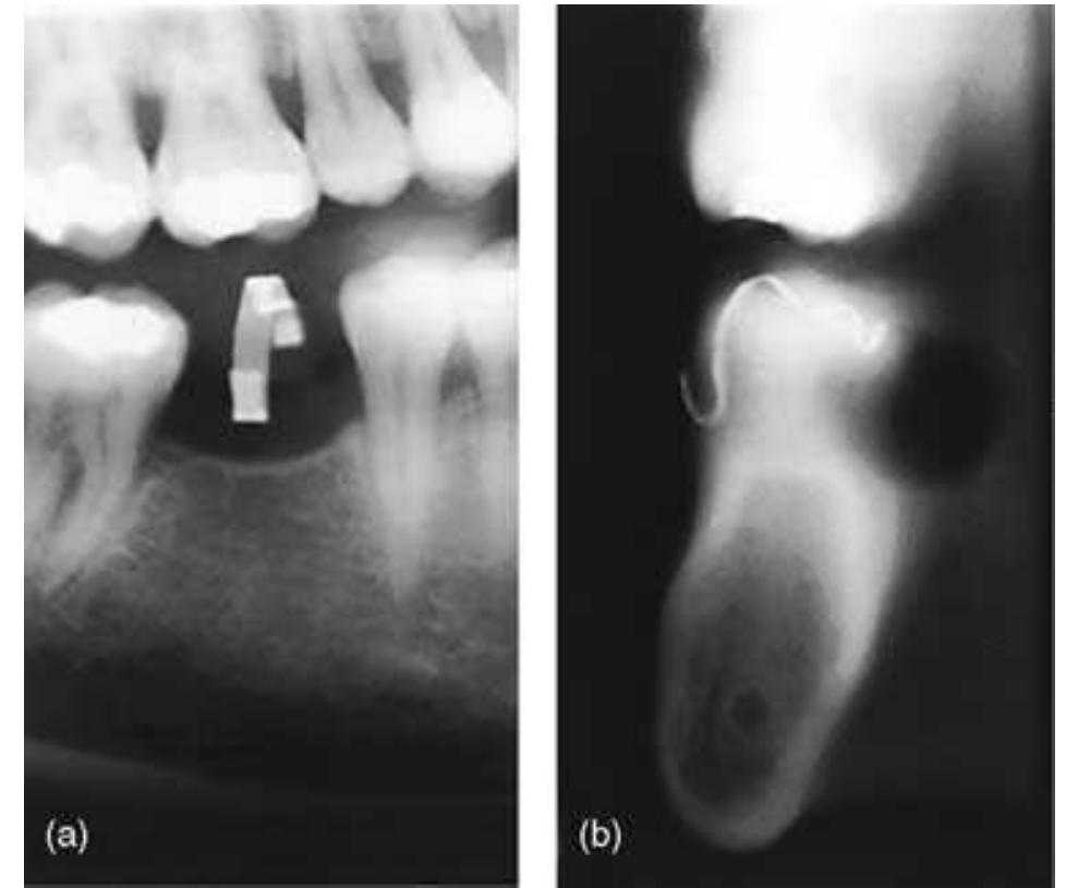 Example of parasagittal (a) and paracoronal (b)