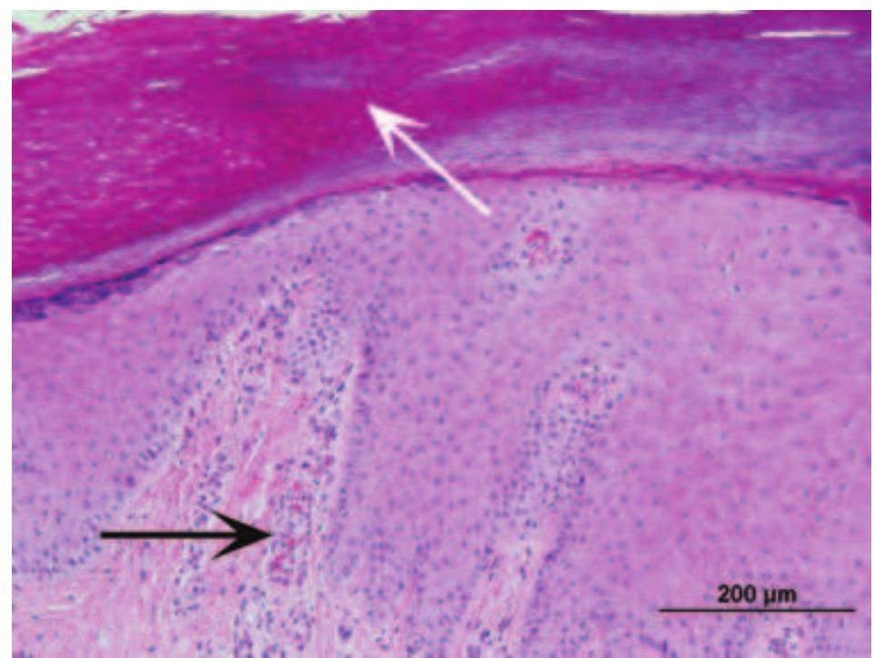 Photomicrograph of skin-biopsy specimen from an alpaca with