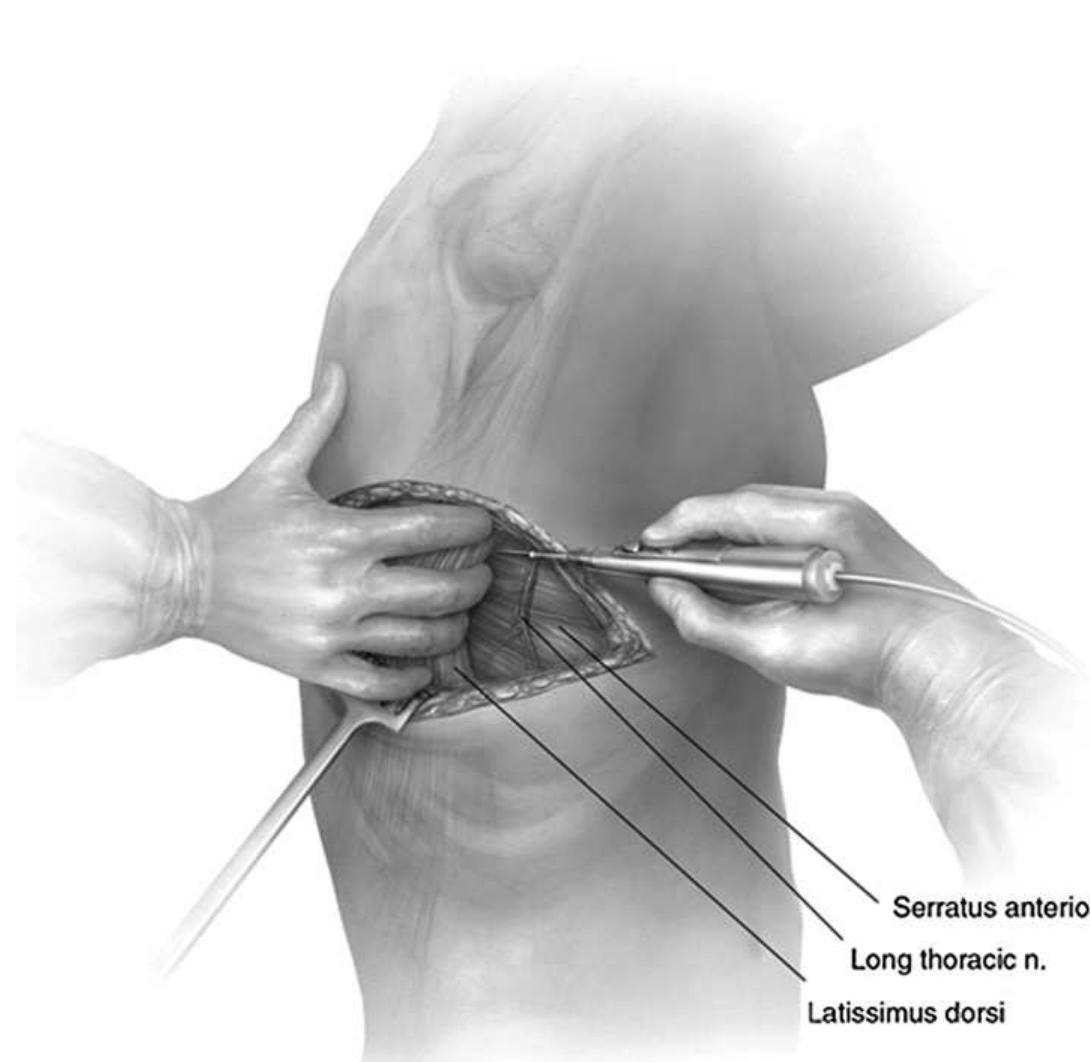 The anterior border of the latissimus dorsi is identified