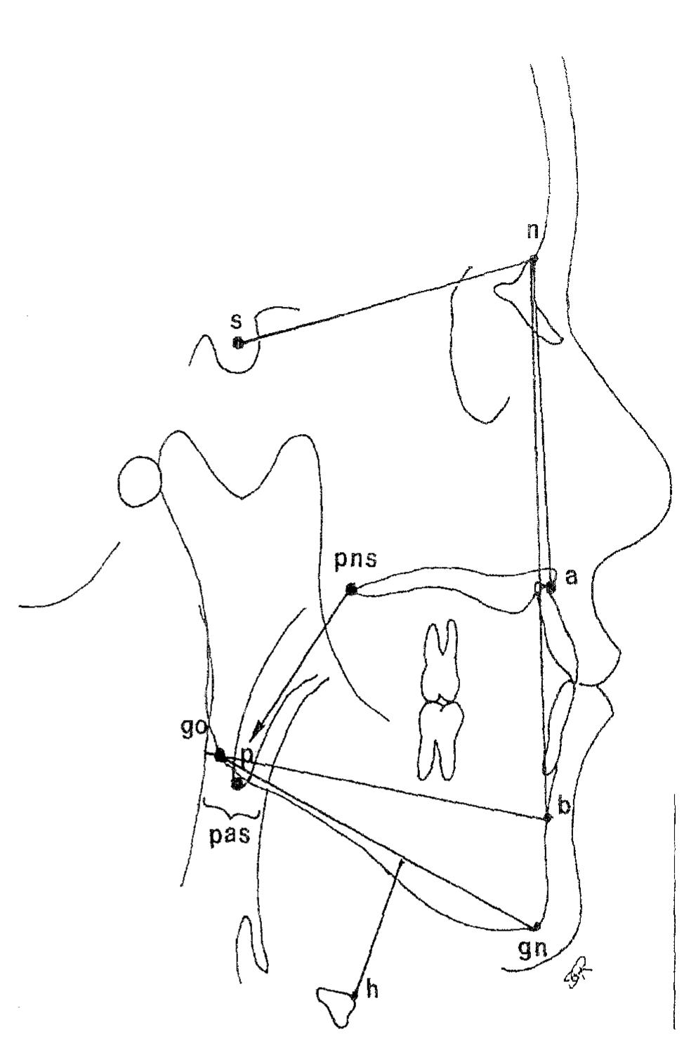 Standard cephalometric measurements. pas, pos- terior airway