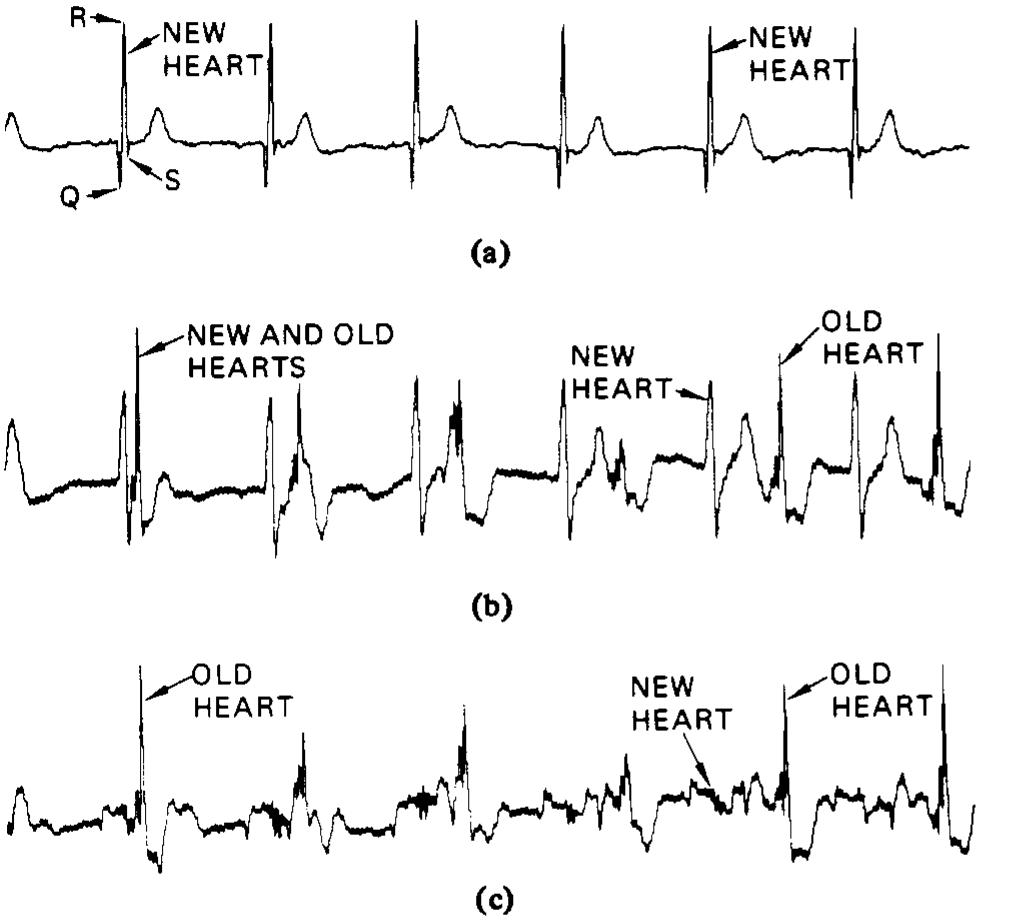 Ecg waveforms of heart-transplant patient. (a) reference in-