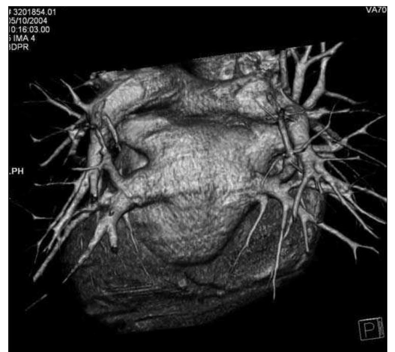 3d reconstruction multislice ct scan. posterior view. the