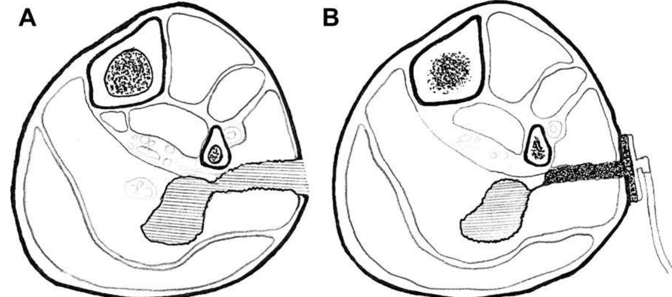 Drawings depicting how a sawd may promote abscess formation