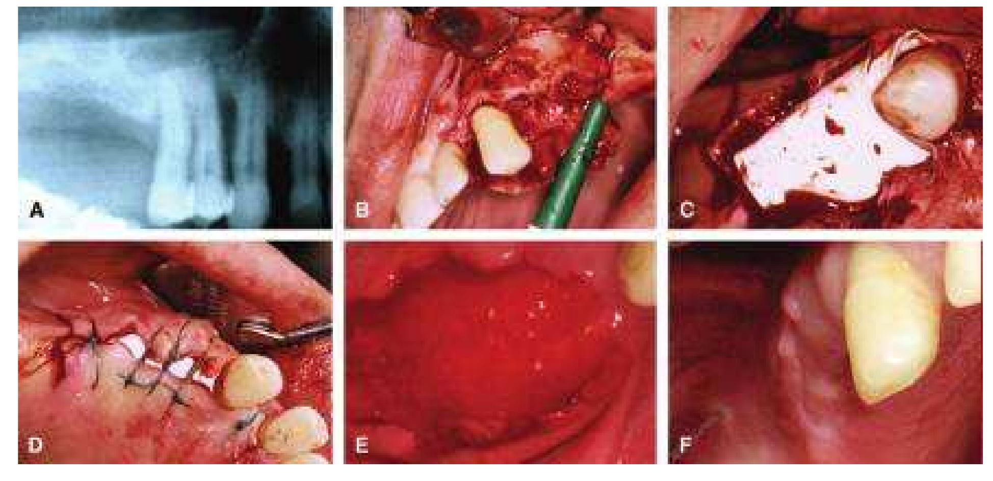 : se * ff surgical procedure, case |, maxilla. a) initial