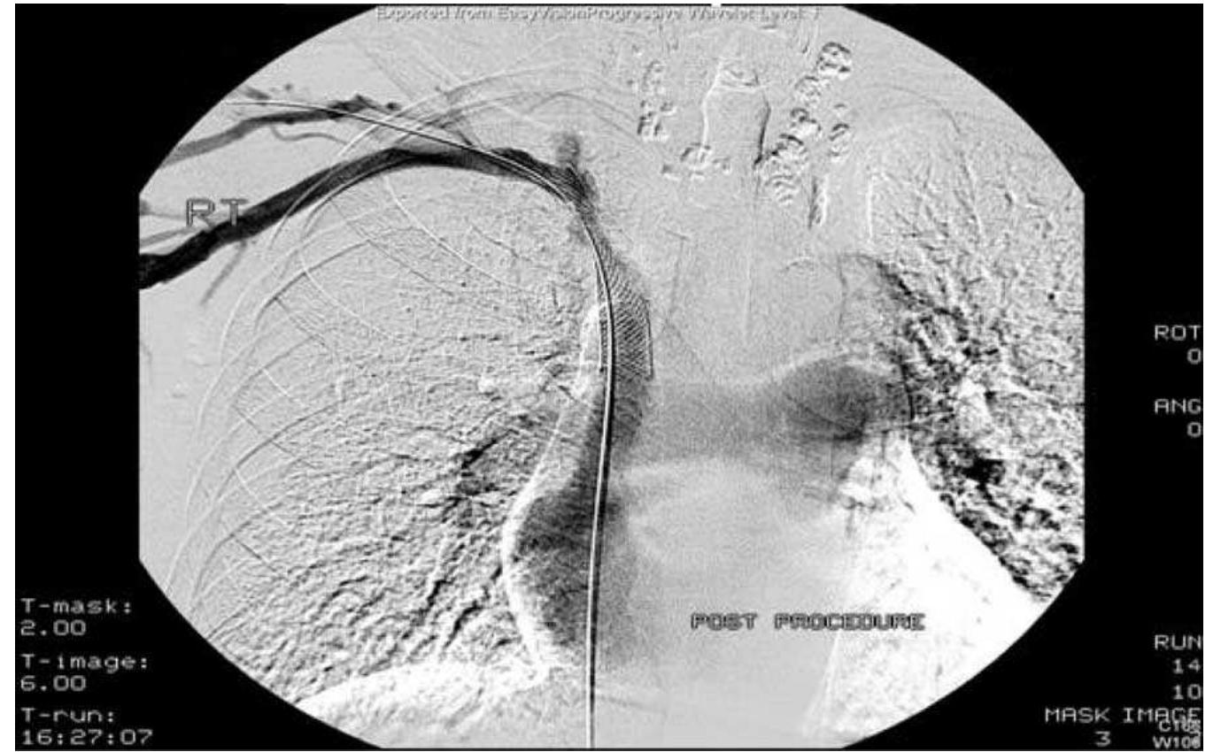 Venoplasty with stenting for right subclavian vein stenosis.