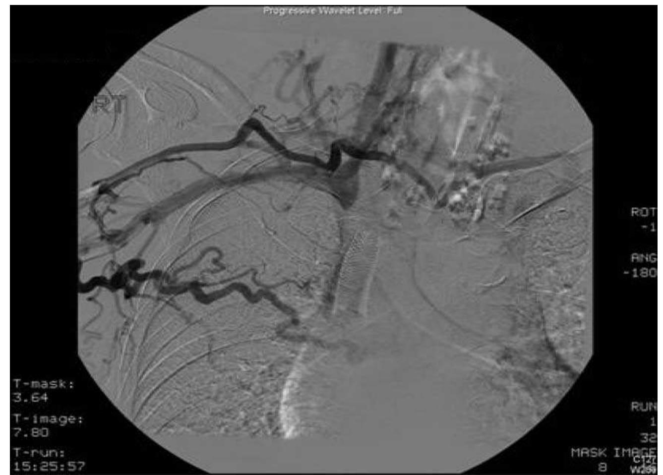 Stent migration to the superior vena cava with venous