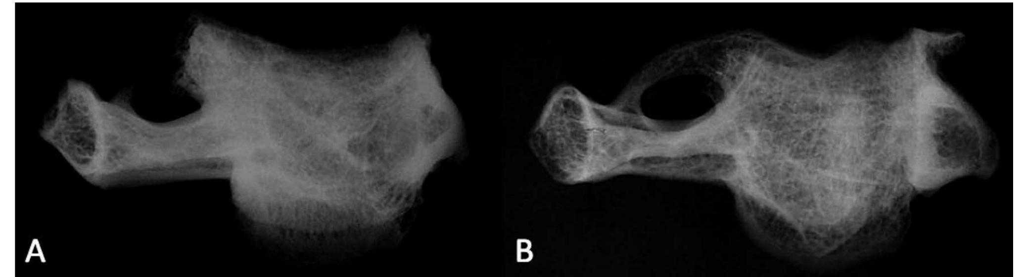 Examples of ossification of the vertebral artery bony ring.