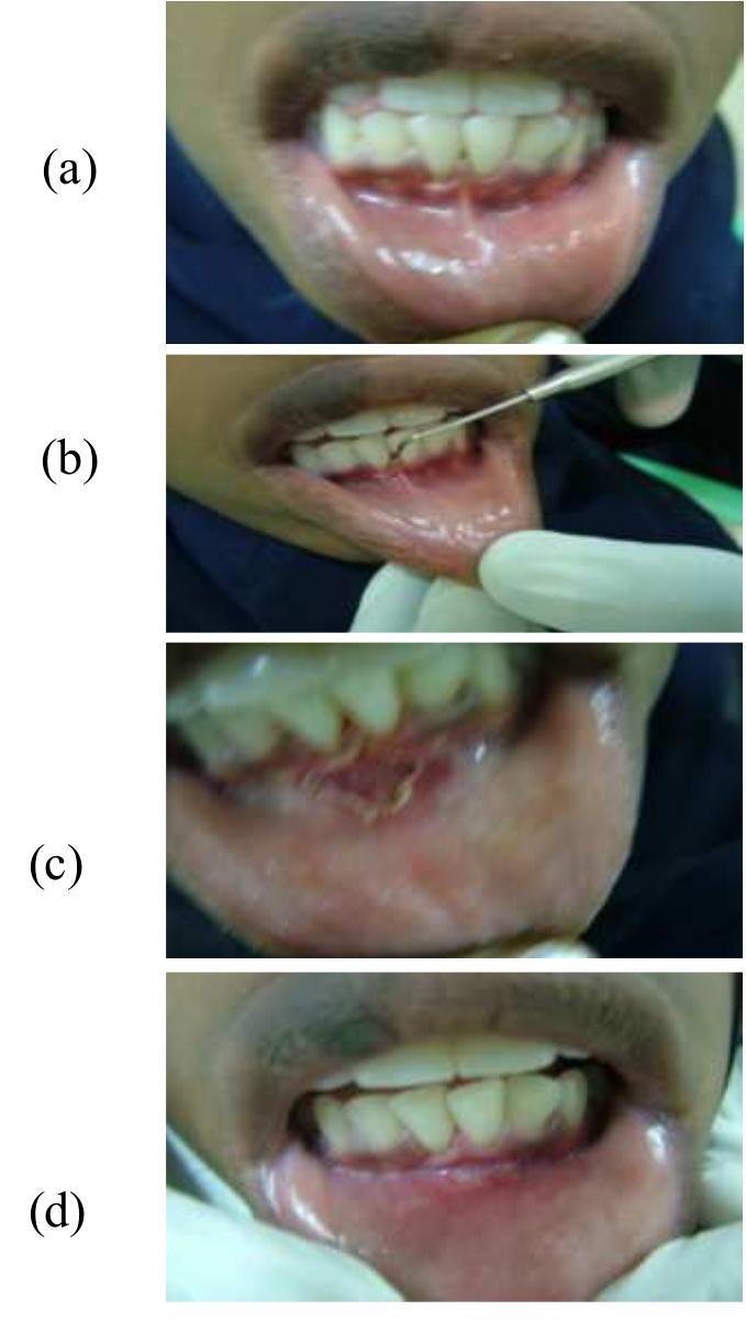 14 years old female with lower labial frenum causing