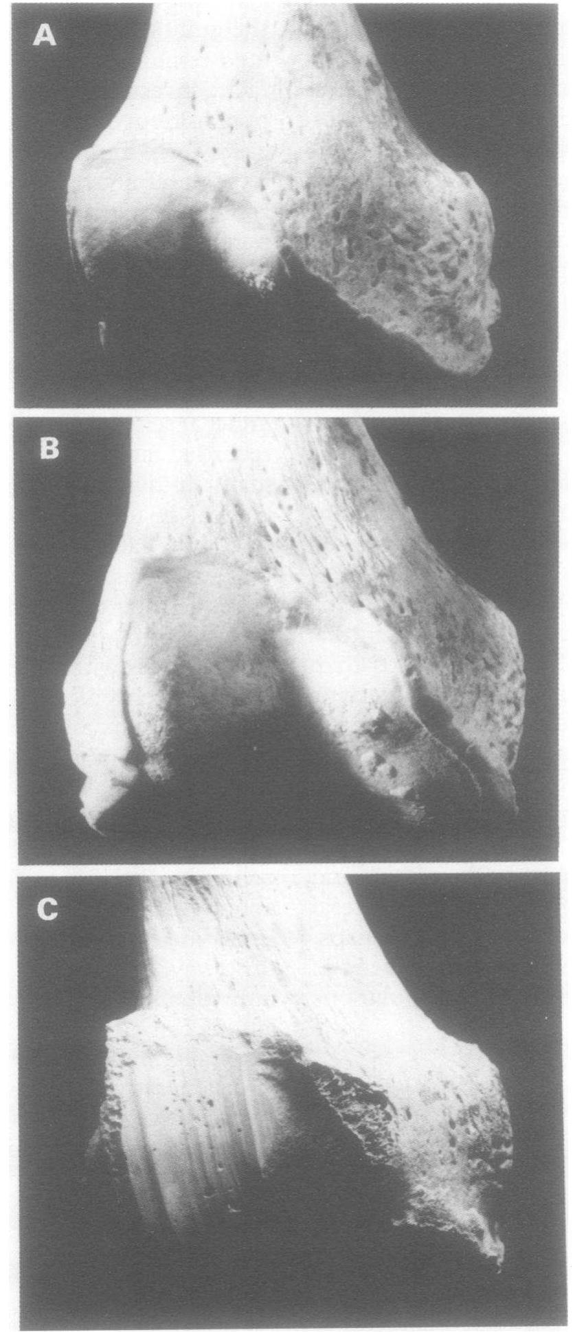 Stages of osteoarthritis as shown in the knee. a: slight