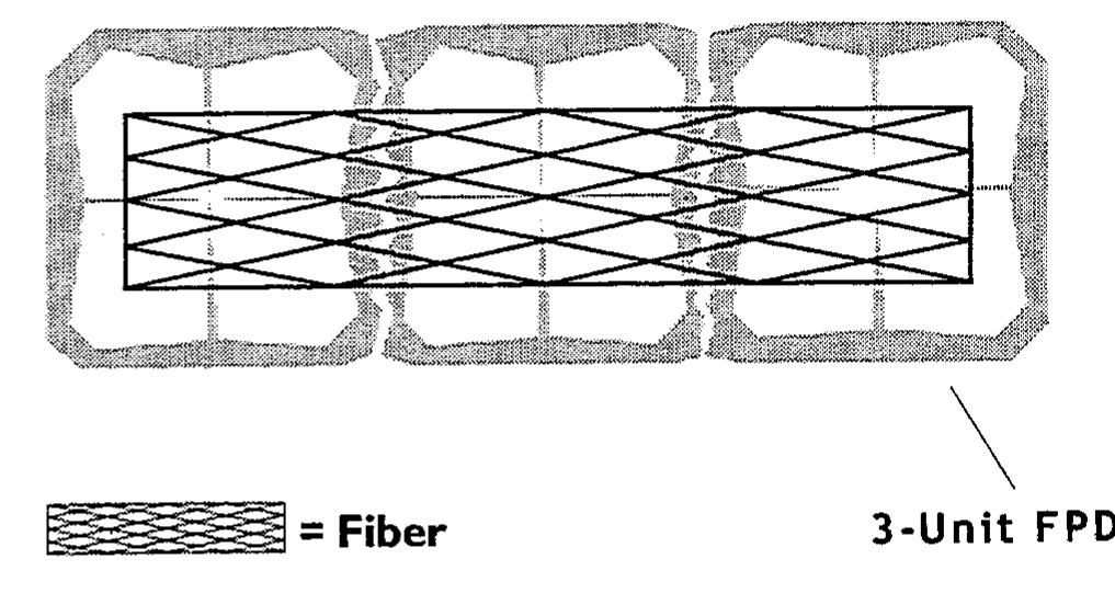 Schematic representation of “unseparated” fracture. fig. 3.
