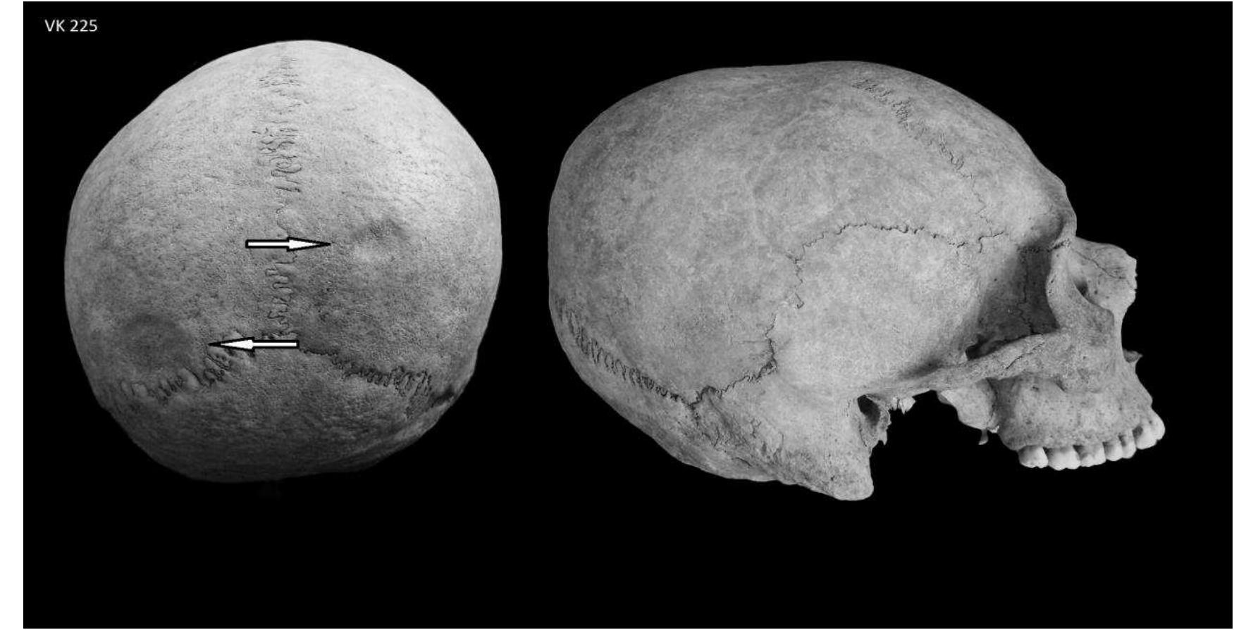Depression fracture on the parietals (a) and head