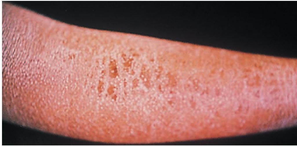 5 skin changes in protein—energy malnutrition.