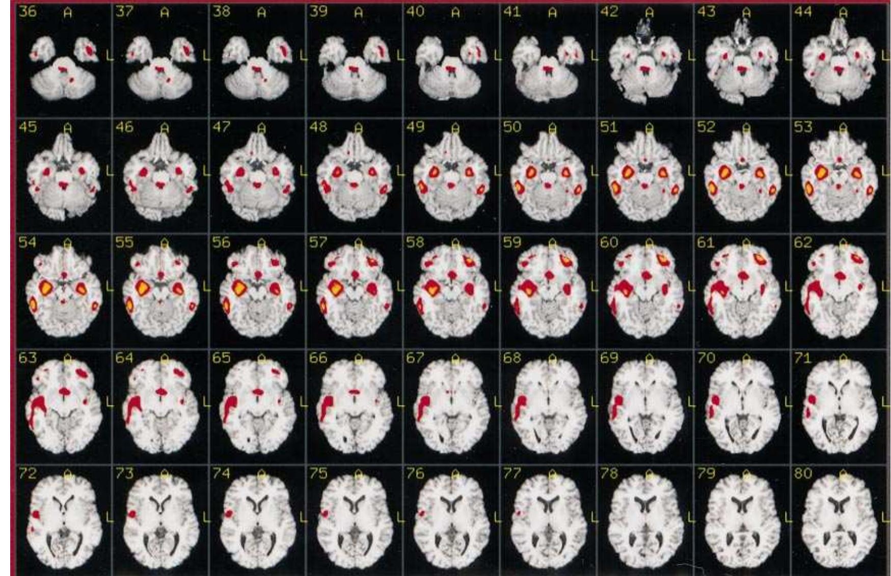 Spm maps showing regions with lower glucose metabolism in