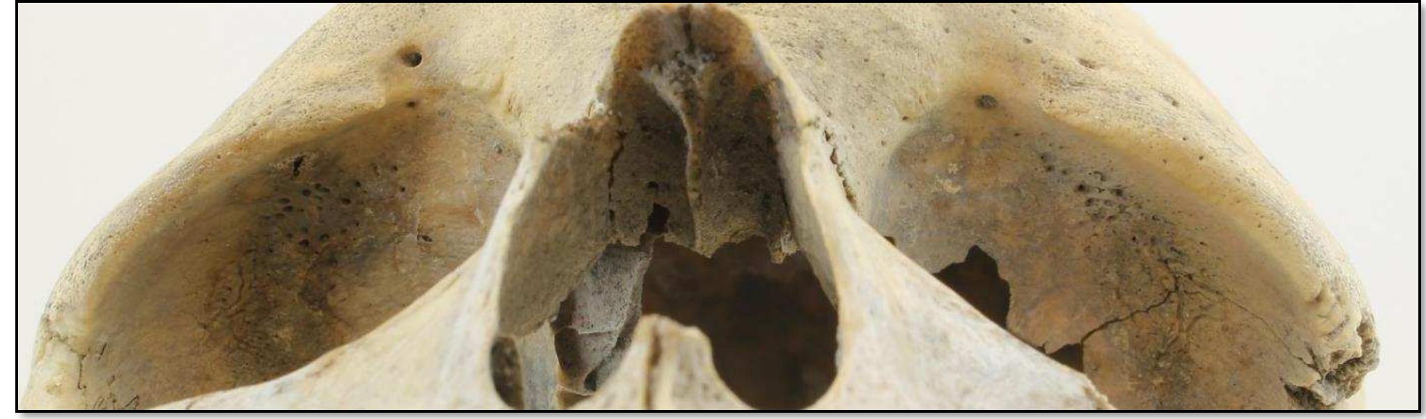 Bilateral cribra orbitalia affecting both orbits of the