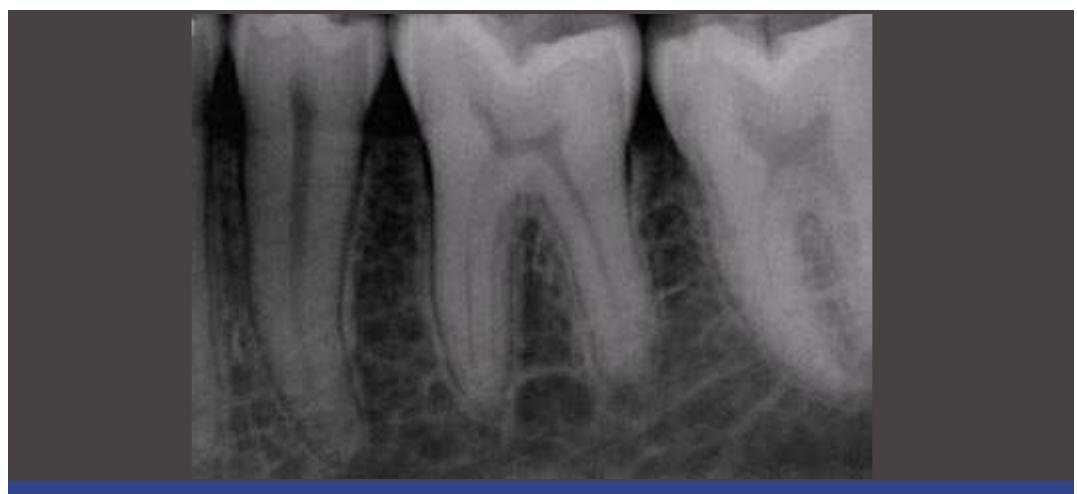 [table/fig 2]: intraoral periapical radiograph showing