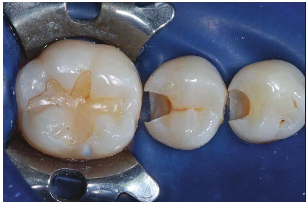 Occlusal view of cavity preparations showing preservation of