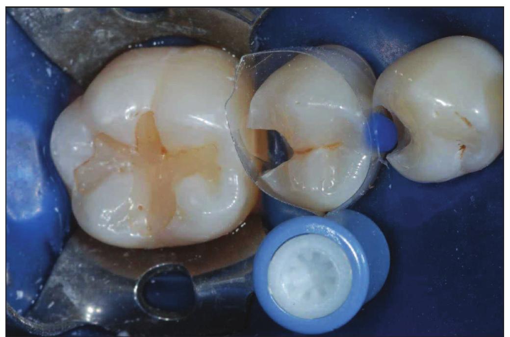Etching was performed using 35% phosphoric acid. figure 4. a