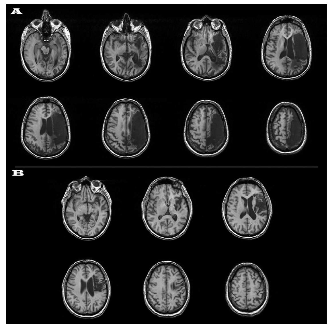 Structural 3t mri scans for two patients of the twelve