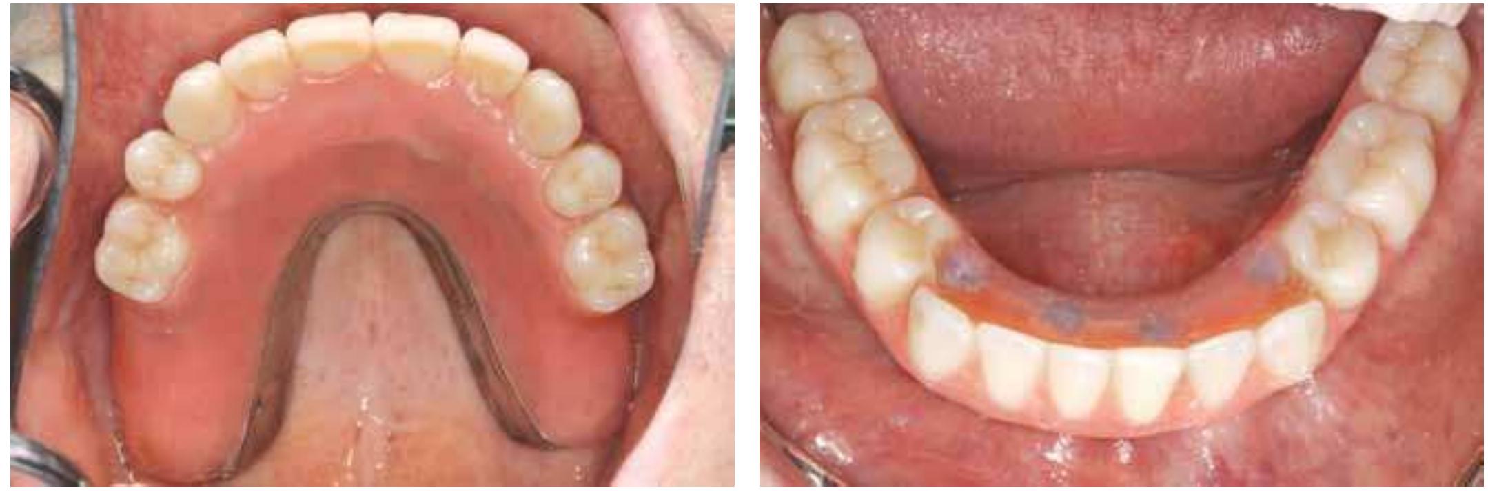 Een occlusal view of maxillary overdenture. occlusal view of