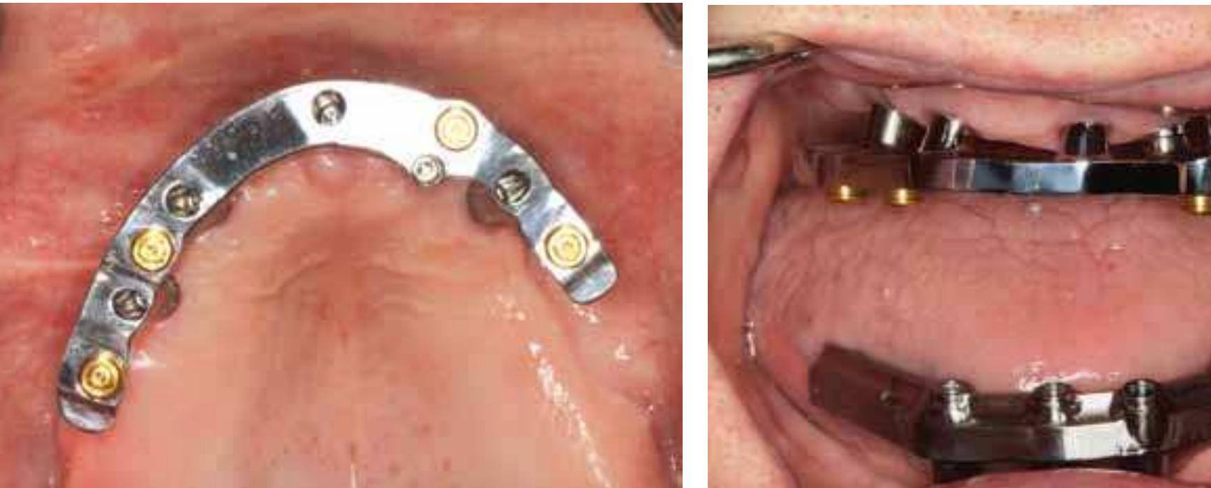 Be) occlusal view of maxillary bar. il) frontal view of
