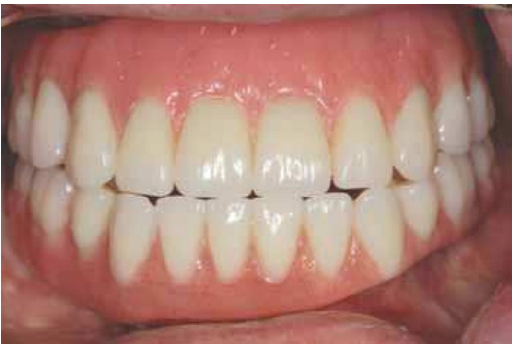 Frontal view of maxillary and mandibular prostheses. achieve