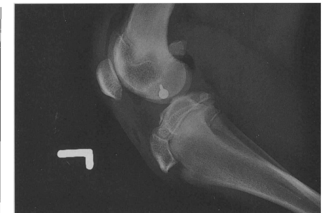 Figure 4 - Avulsion of the popliteus muscle in a malinois