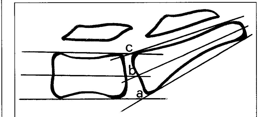 Parameter a; lumbosacral angle. the angles a, b and c