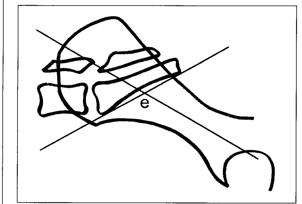 Parameter c; iliosacral angle. the angle e represents the