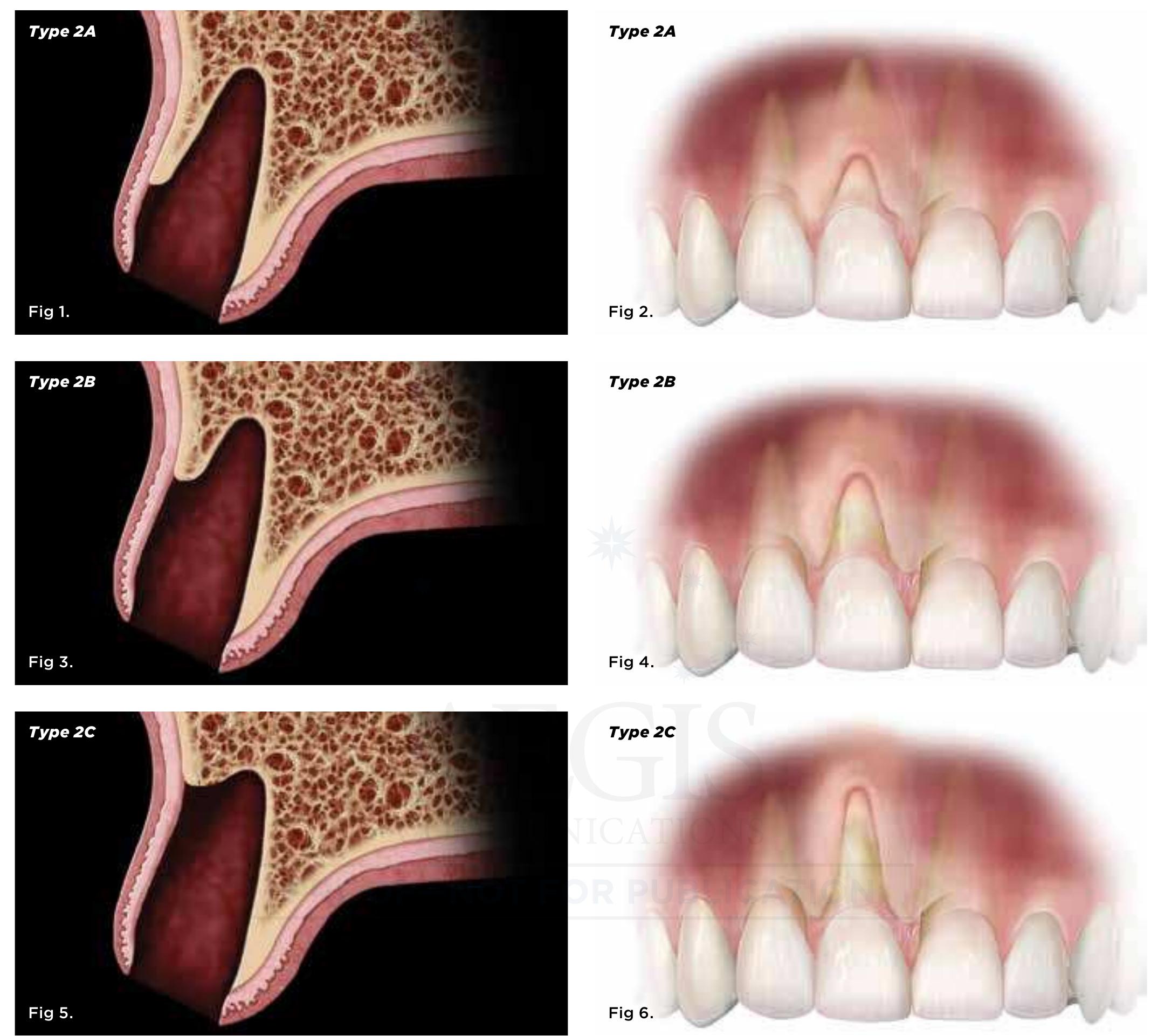 Diagrammatic sagittal view of a type 2a socket, where the