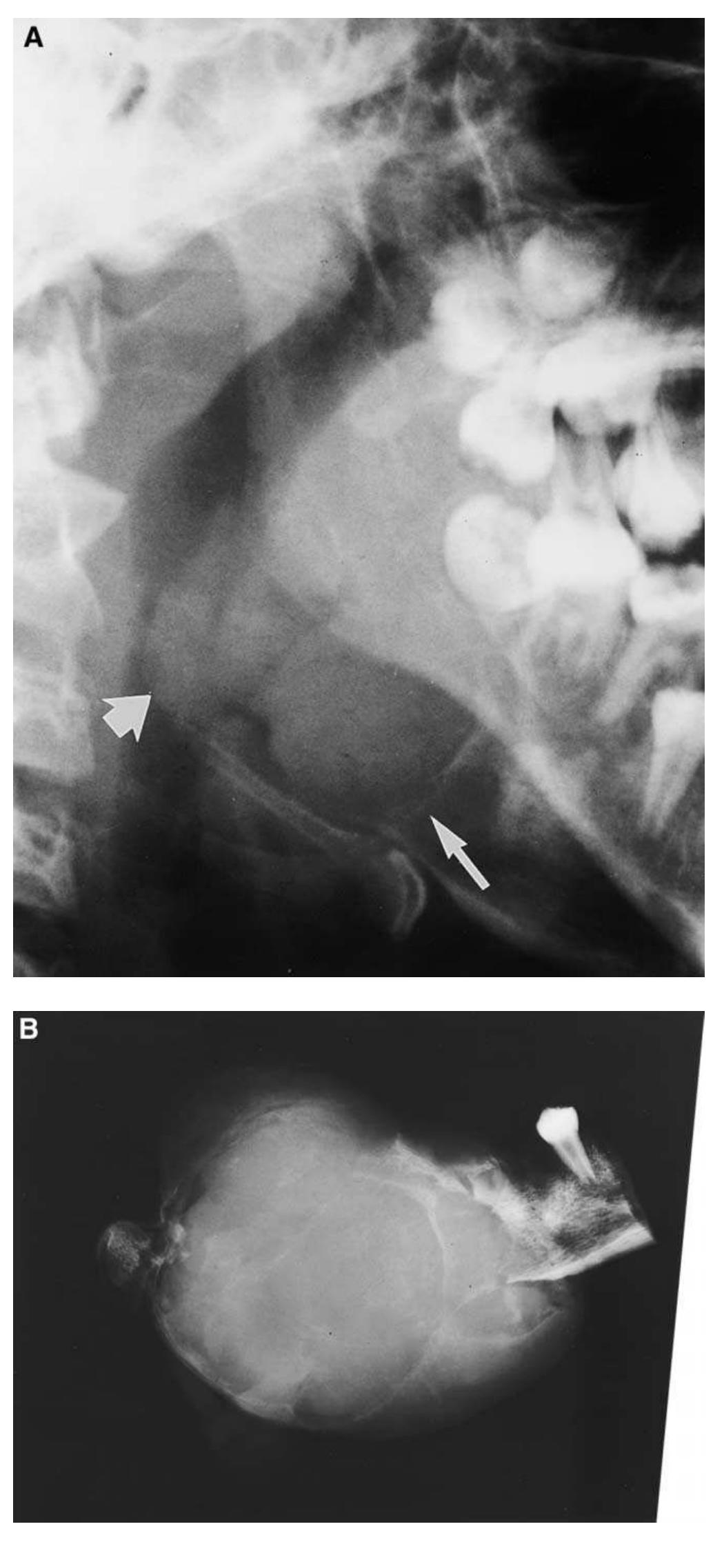 Osteogenic sarcoma. (a) lateral radiograph of the mandible