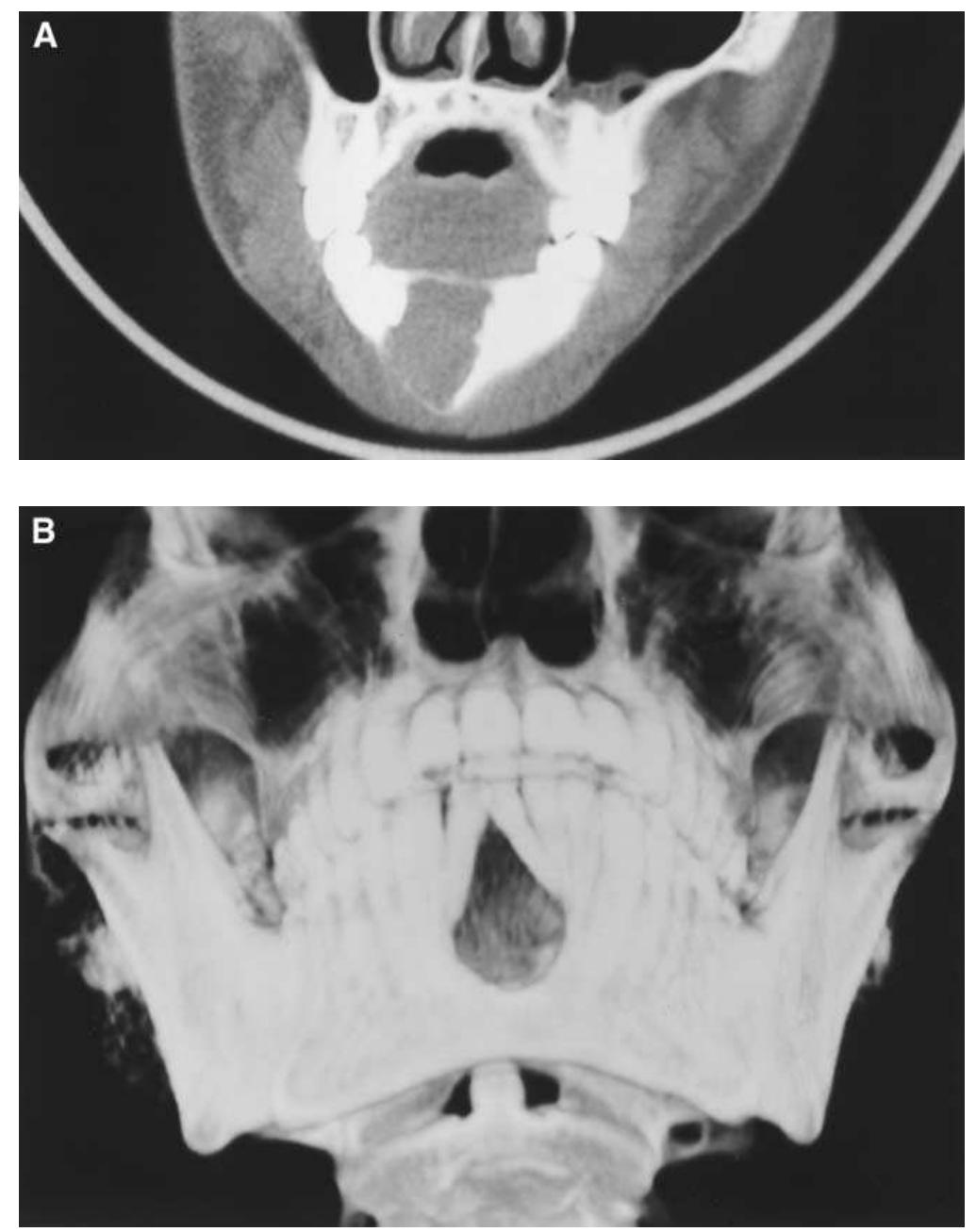 Giant cell-tumor. (a) coronal ct scan shows a large