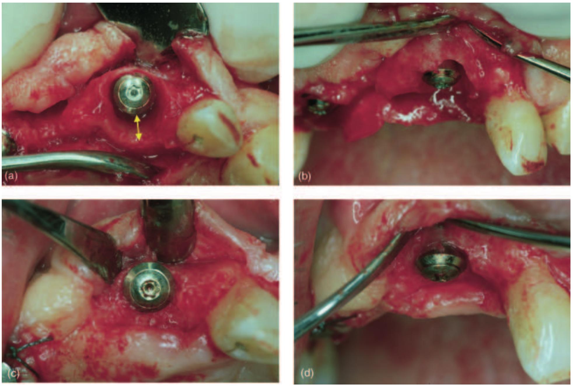 Case e. m. c.: the implant was installed in the extraction