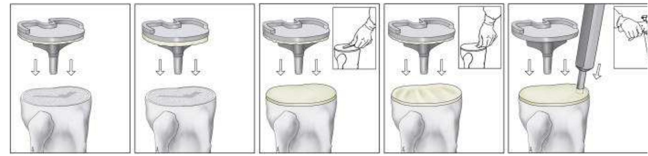 The five different cementation techniques. component and the