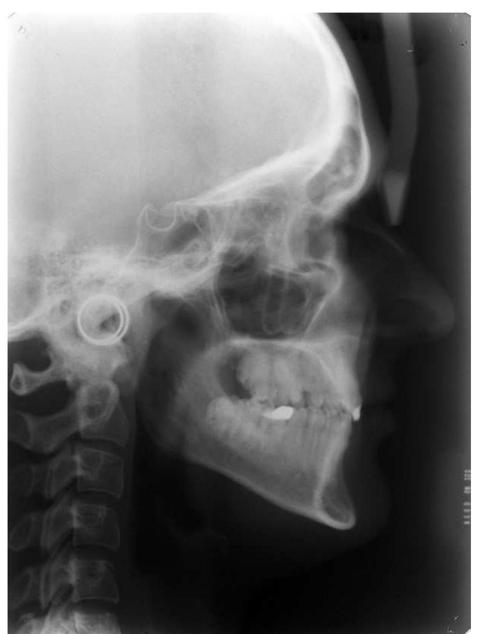 Lateral cephalometric radiograph of case 1.
