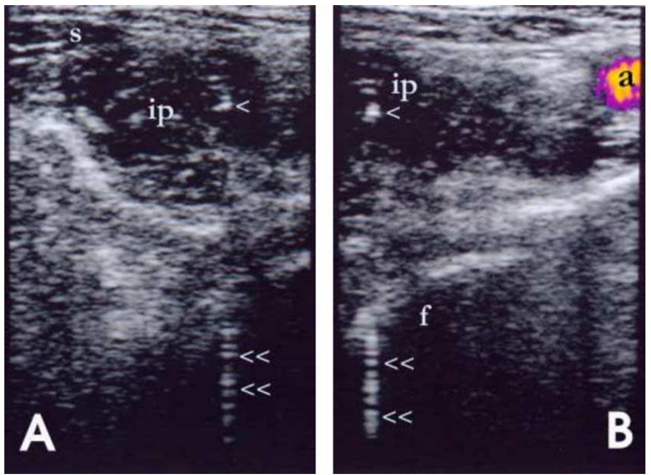 (a and b) transverse ultrasound images of the iliopsoas
