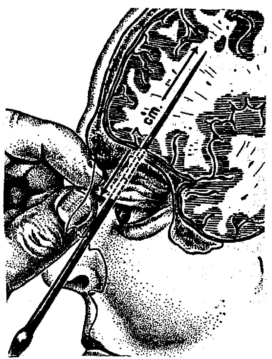 Trans-orbital approach as diagrammed by freeman. (reprinted
