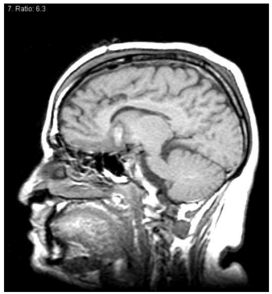 T,-weighted sagittal mri of limbic leucotomy lesions in