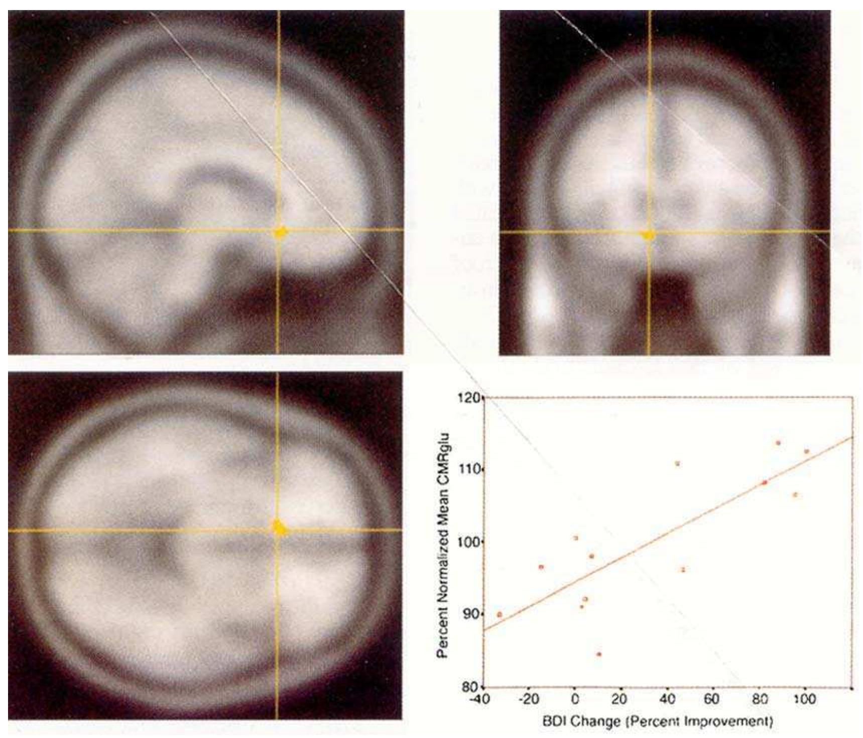 Nominally structural mri images transformed to mni space