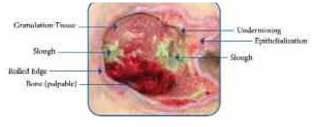 Sacral stage iv pressure ulcer with multiple tissue types.