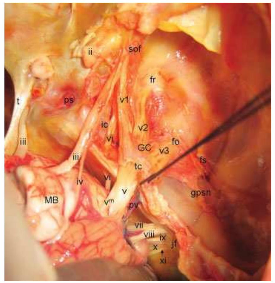 Cranial nerves after cavernous sinus dissection. fo, foramen