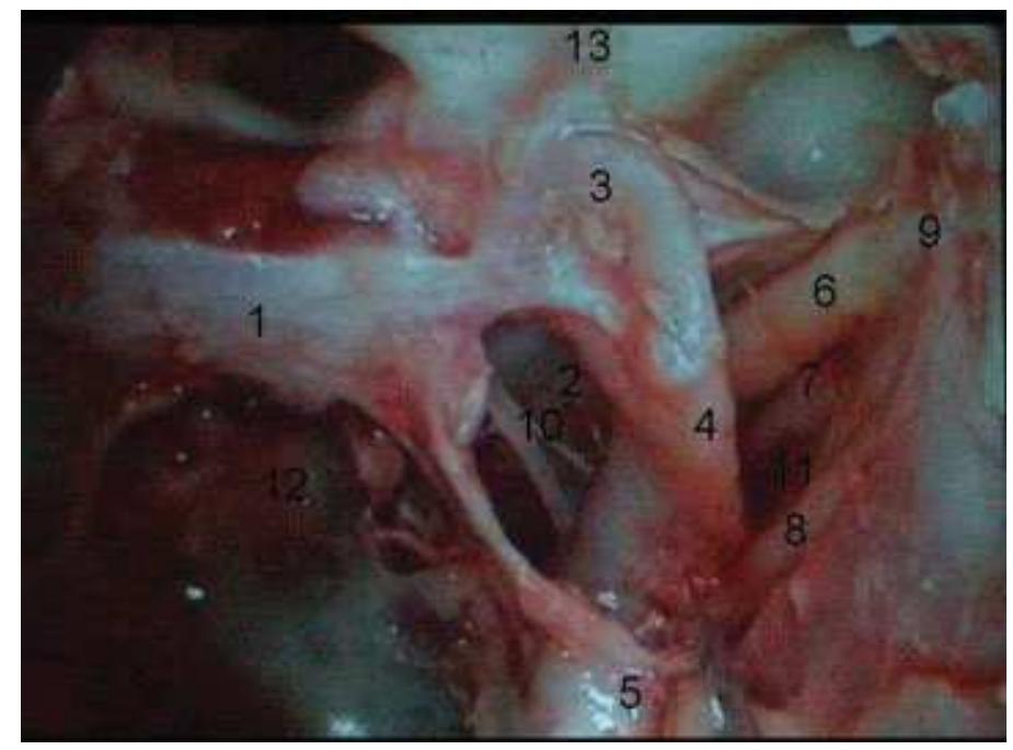 Endoscopic view of cavernous sinus and sella. (1) pituitary