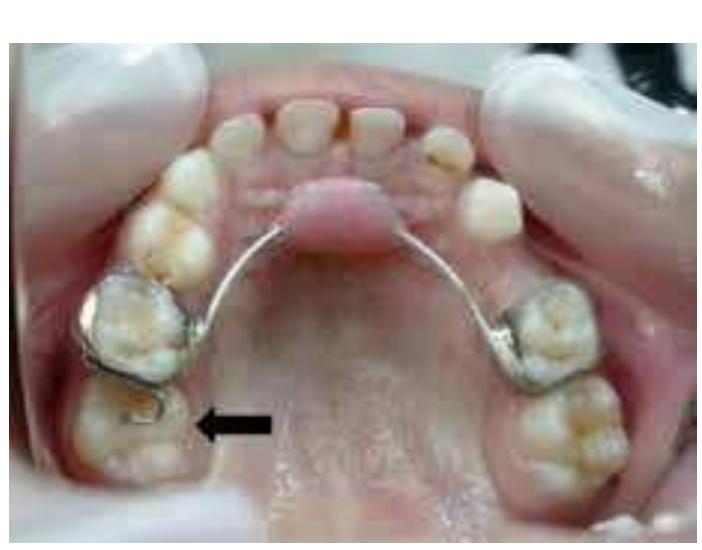 (PDF) A Review of Molar Distalisation Techniques